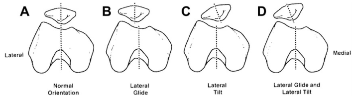 슬개골 외측 활주 증후군/무릎뼈 가쪽 활주 증후군(patellar lateral glide syndrome) : 네이버 블로그