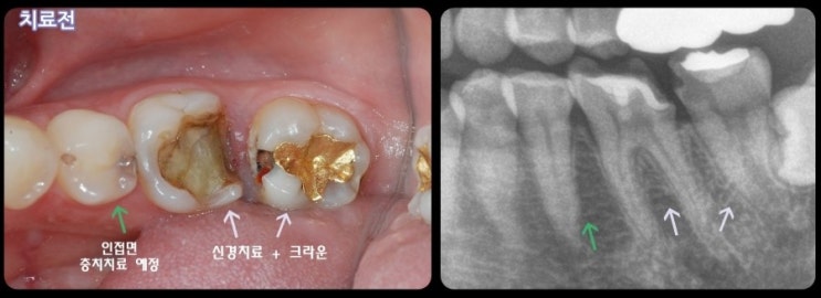 인접면 충치 치아사이충치를 레진으로 치료하면 오래 갈까 18개월 체크 사진 어금니 신경치료 By 진접치과 드림팩토리치과