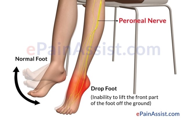 족하수(Foot drop) : 갑자기 발목이 올라가지 않아요 : 네이버 블로그