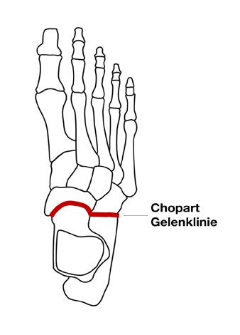 쇼파르 관절염(Chopart's arthritis) : 옛날부터 자주 달리기를 했는데 40세를 넘어서는 달리면 가끔 발등이 아파 ...