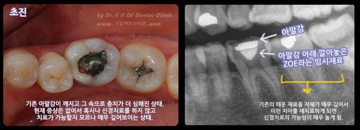 인접면 충치치아사이충치 오래된 아말감 주변 깊은 이차 충치 를 레진으로 치료 하기 By 진접치과 드림팩토리치과 네이버 블로그