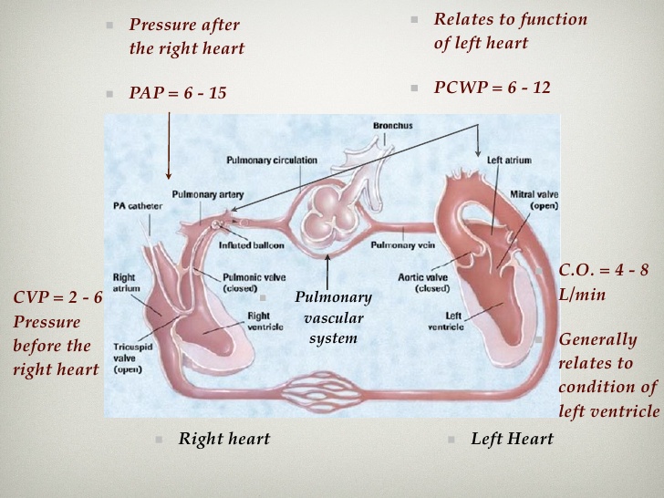 혈압 조절 기전의 실패, 고혈압 치료 기전 CVP PCWP [임상 생리학 clinical physiology] : 네이버 블로그
