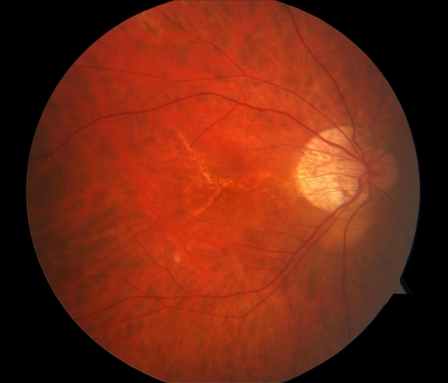 병적근시:pathologic myopia_마포 공덕서울안과 : 네이버 블로그