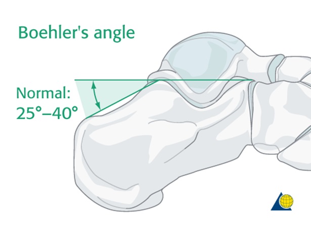 Boehler’s angle : 네이버 블로그