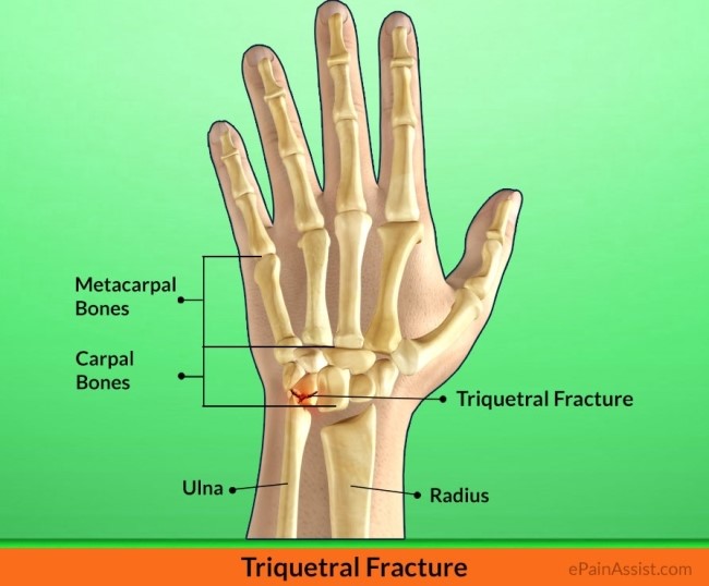 삼각골 골절(Triquetrum fracture) : 넘어지면서 팔을 펴고 짚은 뒤 삼각골이 부러졌어요 : 네이버 블로그