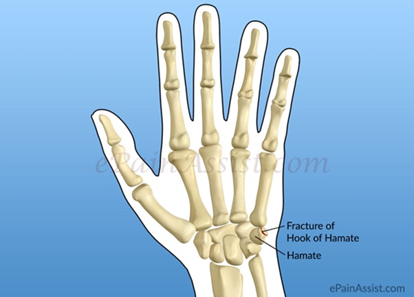 갈고리뼈 골절(Hamate fracture) : 골프를 치다가 갈고리뼈에 강한 힘을 받은 후 골절이 생겼어요 : 네이버 블로그