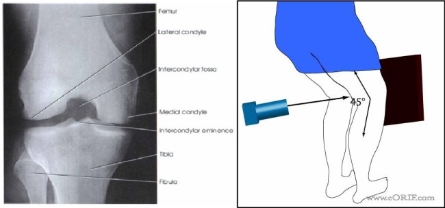 intercondylar notch view x ray