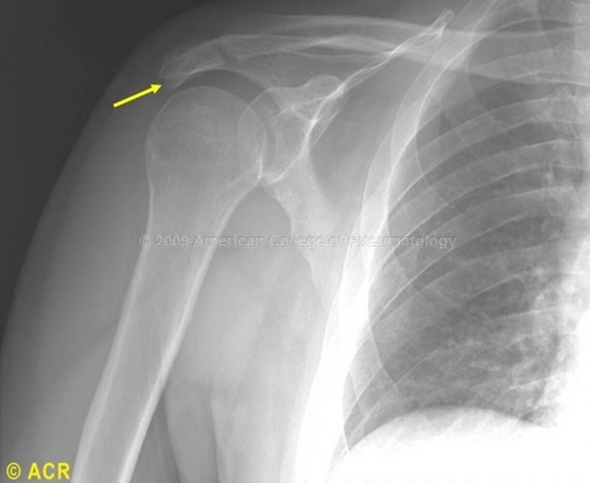 Shoulder X-ray의 Normal variation : 네이버 블로그