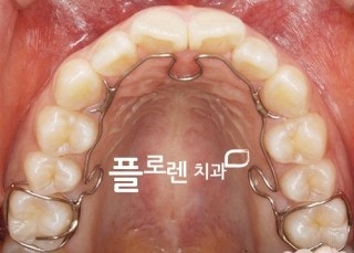 플로렌 10주년 그리고 ALF(Advanced Lightwire Functional Appliance-알프,앨프) -2 ...