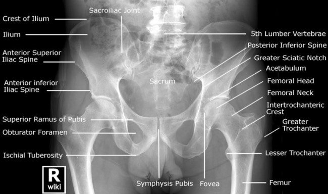 Pelvic X-ray의 Anatomy와 Positioning : 네이버 블로그
