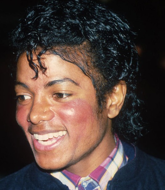 [전신홍반루프스] 마이클잭슨이 앓았던 병! 전신홍반루프스(systemic lupus erythematosus; SLE)를 ...