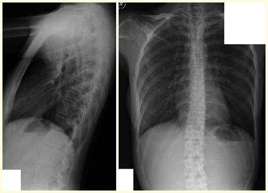 흉추 회전신전 증후군/등뼈 돌림폄 증후군(thoracic rotation-extension syndrome) : 네이버 블로그