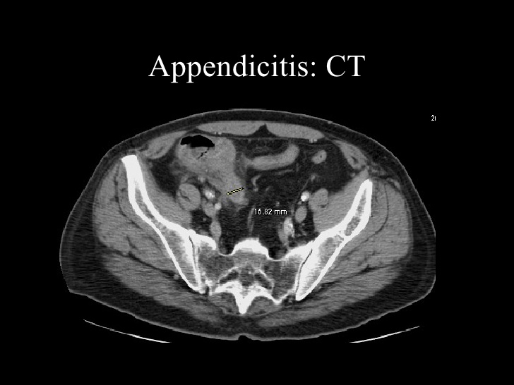 Appendicitis CT 소견 : 네이버 블로그