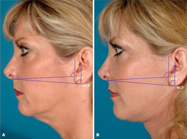 QUILL Lifting (SMAS Lifting / SMAS 리프팅 / 주름성형) by Dr. Joseph O'Connell ...