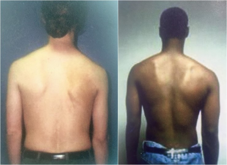 경추 신전회전 증후군/목뼈 폄돌림 증후군(cervical extension-rotation syndrome) : 네이버 블로그