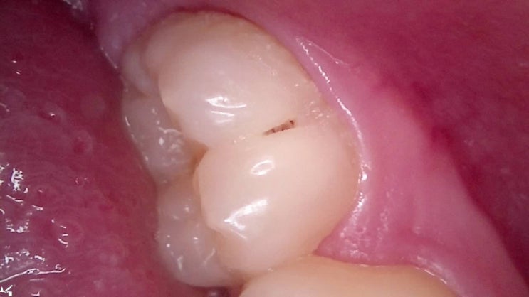 [일원동 치과 전문의] 서울 삼성치과 buccal pit caries 구치부 협면 소와 우식 : 네이버 블로그
