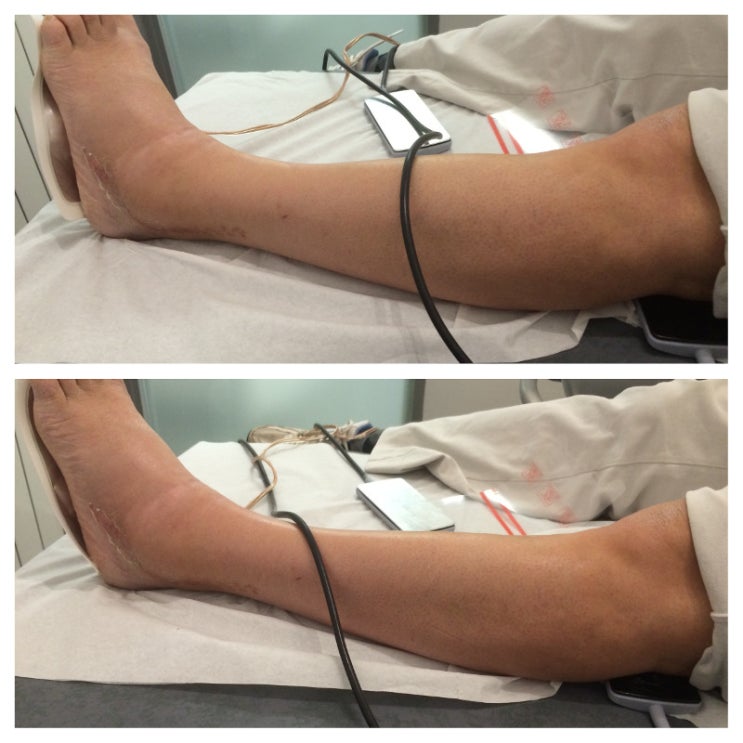 윈백WINBACK_테카테크닉2.0(TECAR 2.0)의 활용 : 네이버 블로그