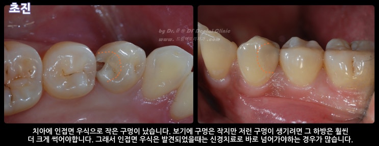 심한 인접면충치 치아사이충치를 Mta치수복조와 레진으로 치료하기 치실 사용과 정기 검진의 중요성 네이버 블로그