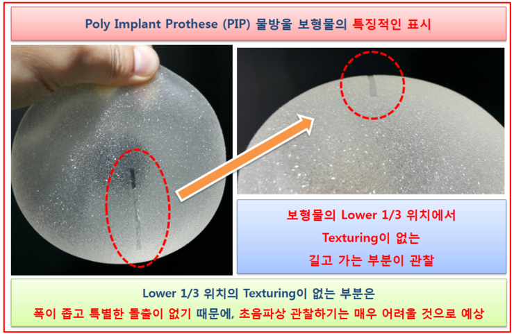 다른 보형물의 Shell 소견 및 Anatomical shape PIP implant 의 외형 - 2 of 2 : 네이버 블로그