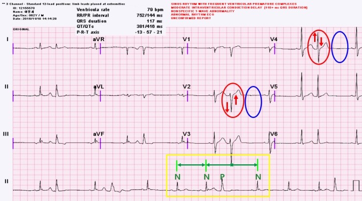 심장리듬 III. 조기박동, 기외수축 : 네이버 블로그