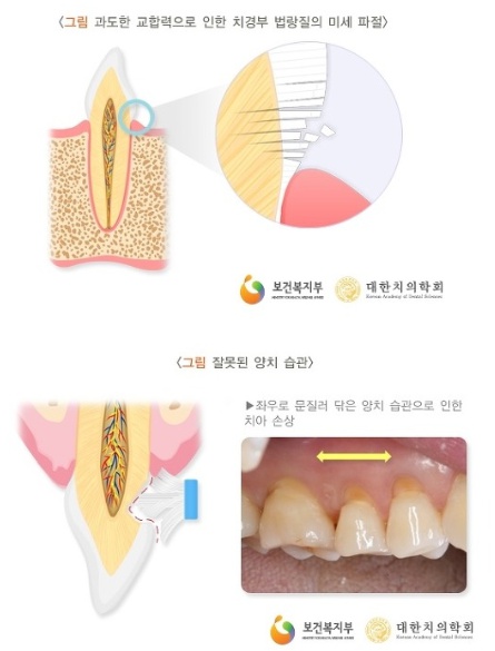 치아가시려요치아가패였어요치아허리가 깨졌어요군포도담치과치경부마모 네이버 블로그