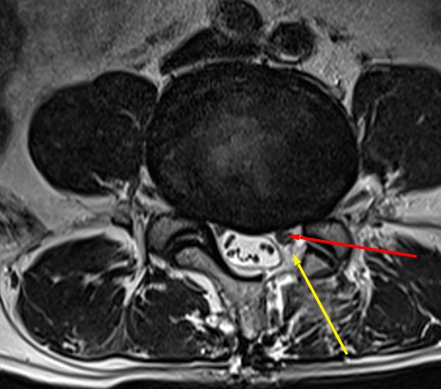 척추관 협착증(Spinal stneosis) 치료 중 미세현미경 감압술 (partial hemilaminectomy and ...