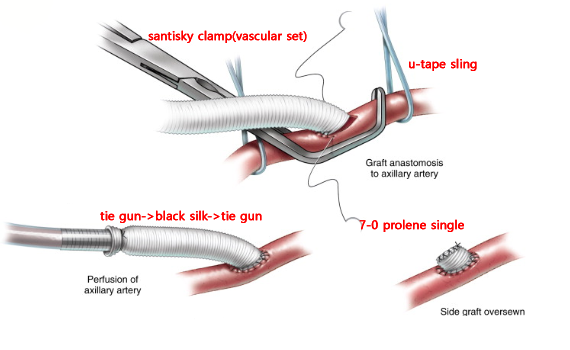 Aorta type 1 dissection (axillary cannulation) : 네이버 블로그