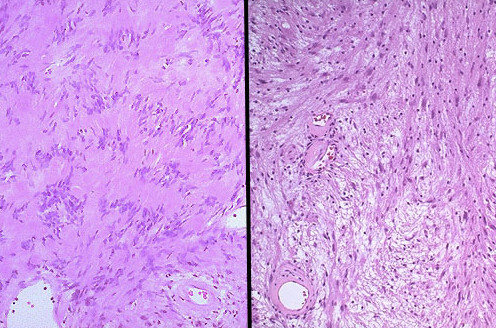 neurilemmoma (vestibular schwannoma) / acoustic neuroma : 네이버 블로그