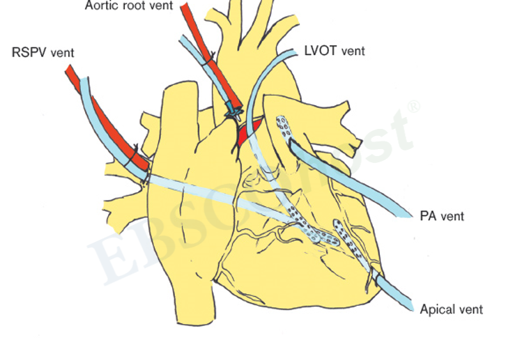 AVR+CABG (2016/11/7) : 네이버 블로그