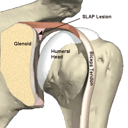[광교PT 케어핏 광교피티] "상부관절와순병변 SLAP Lesion (Superior Labrum anterior to ...