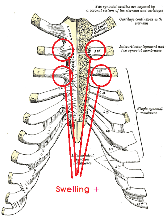 [Tietze 증후군] 가슴이 가운데가 아프고 만지면 부종이 있어요! - Tietze's Syndrome : 네이버 블로그