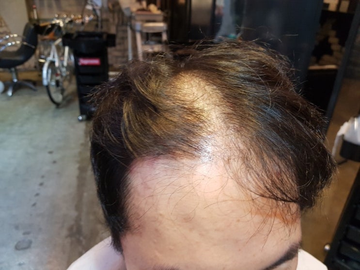 참 힘들고 괴롭습니다 남자 엠자이마 탈모머리에 어울리는 헤어스타일 네이버 블로그