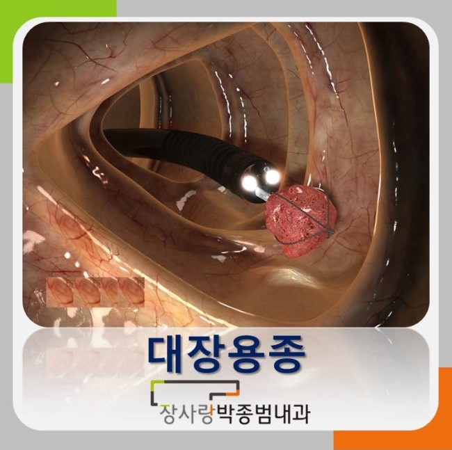 청주내과 대장용종 속속들이 알아보기 2 대장용종의 분류 네이버 블로그