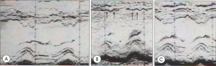 3-009-03 regional wall motion abnormality(국소벽운동이상, RWMA)의 평가 : 네이버 블로그
