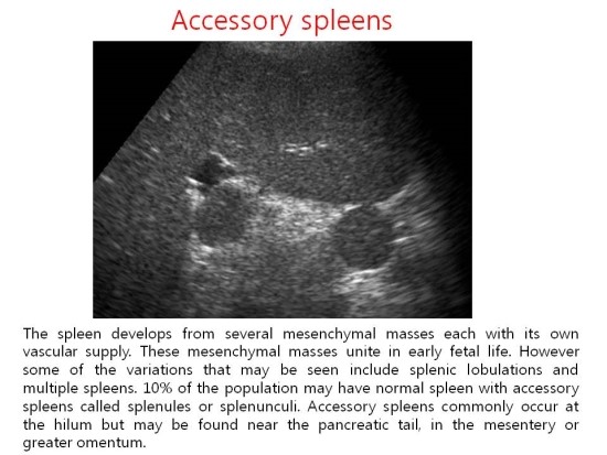다발성 부비(덧지라) multiple accessory spleens : 네이버 블로그
