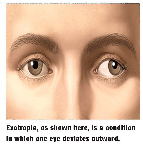 외사시(exotropia)는 무엇인가요? : 네이버 블로그