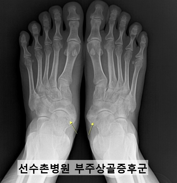 부주상골증후군수술 kidner procedure : 네이버 블로그