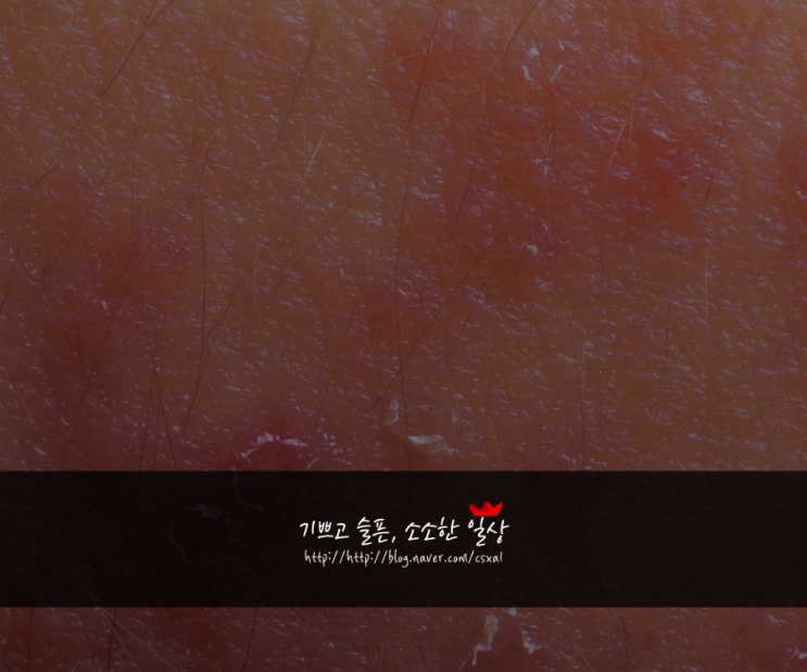 사타구니 습진 연고 바르면서 아토피 가려움 탈출하기 네이버 블로그