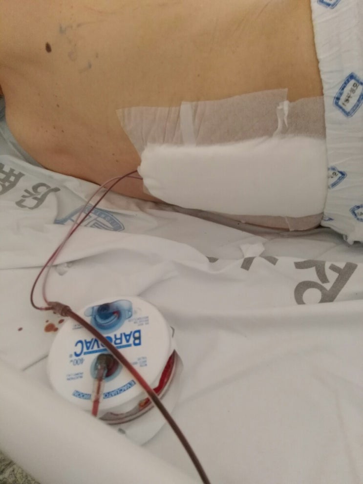 아버지허리수술 척추협착감압술및후방 네이버 블로그