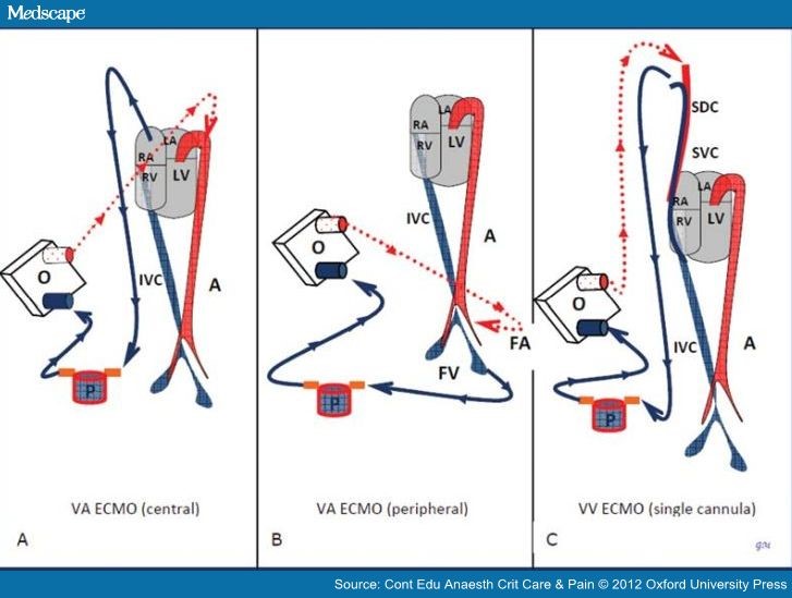 ECMO insertion : 네이버 블로그
