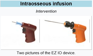 intraosseous infusion : 네이버 블로그
