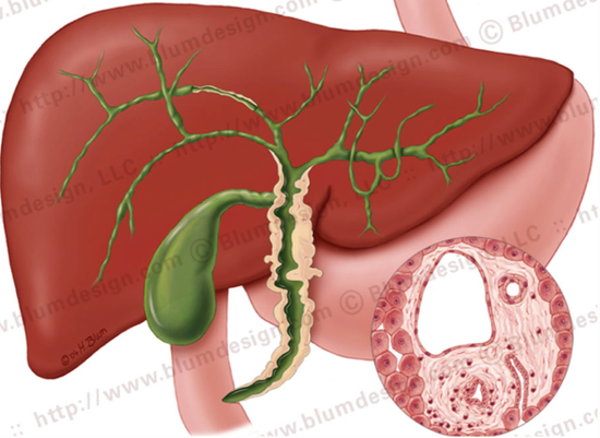 원발성 담즙성 간경변증(primary biliary cirrhosis : PBC) 혹은 원발성 담즙성 담관염(primary ...