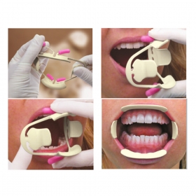 교정장치 붙이기 아픈가요? : 네이버 블로그