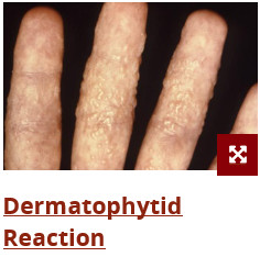 dermatophytid reaction : 네이버 블로그