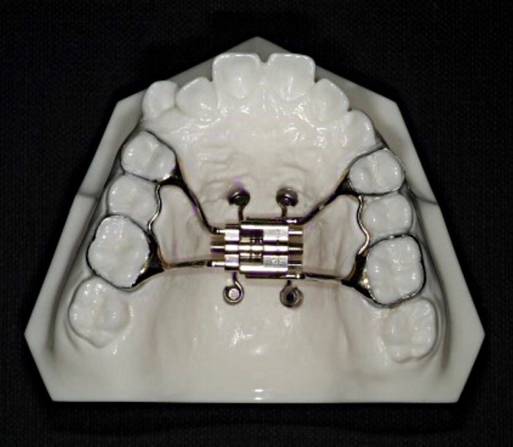 MARPE (miniscrew assisted rapid palatal expansion) : 네이버 블로그