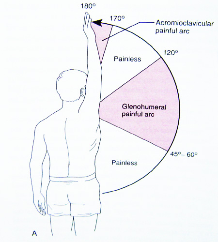 Painful Arc Syndrome - Shoulder Impingement : 네이버 블로그