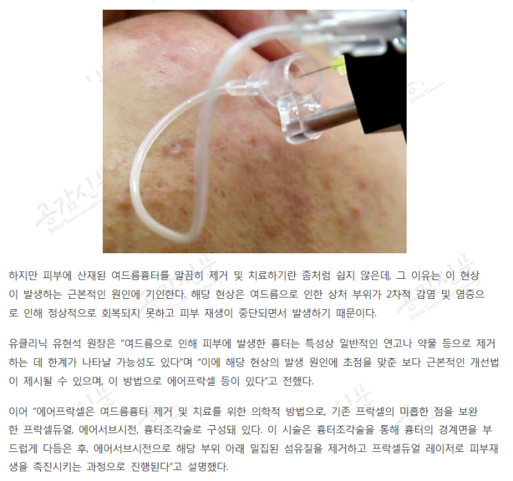 프락셀듀얼 포함된 에어프락셀 여드름흉터 제거 및 치료에 효과적 네이버 블로그