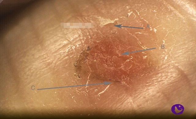 편평사마귀 원인과 재발 (HPV56) : 네이버 블로그
