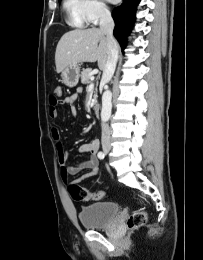 GS Vascular 발표 - isolated spontaneous SMA dissection [외과 파견] : 네이버 블로그
