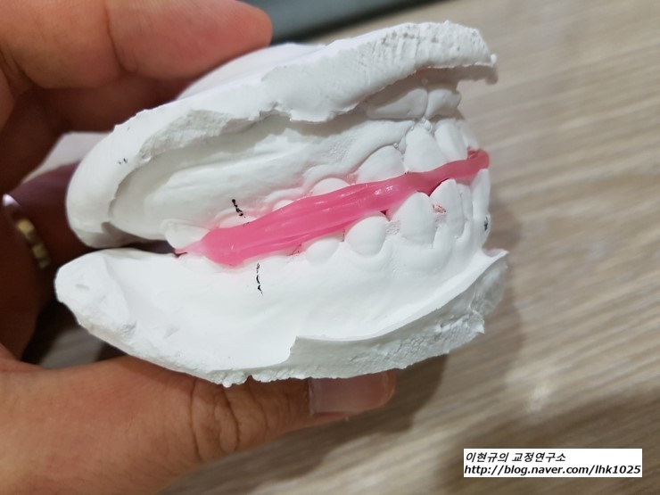 진단모델 바이트 채득시 주의사항 (Bite impression) : 네이버 블로그